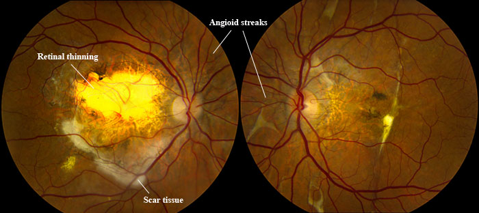 Angioid Streaks Retina 970-226-0959 - Harmony EyeCare Center | Dr ...